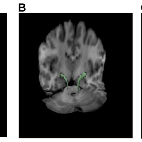 The Three Brainstem Tracts Identified Using Probabilistic Download