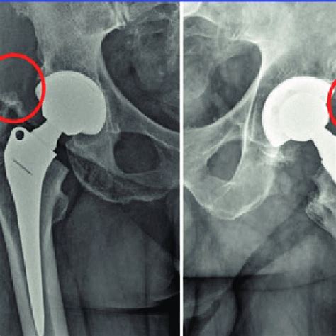 Brooker Classification Of Heterotopic Ossifications Ho A Grade I