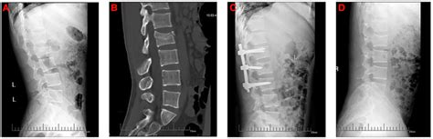 The Preoperative And Postoperative Radiographs Of Six Pedicle Screws