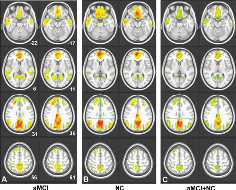 mr images show functional brain deactivations during the episodic