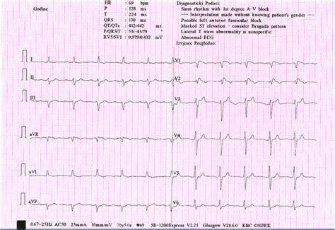 Electrocardiogram Brugada Typ I Pattern Download Scientific Diagram