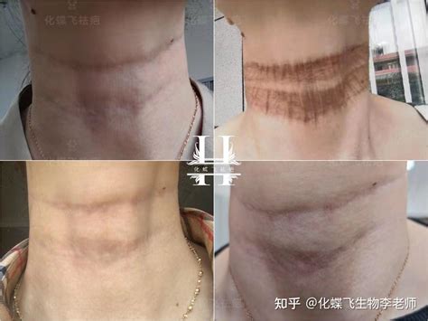 非常严重复杂的去颈纹 知乎