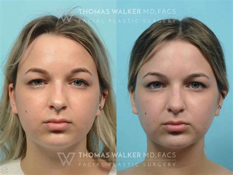 Cheek Fat Reduction