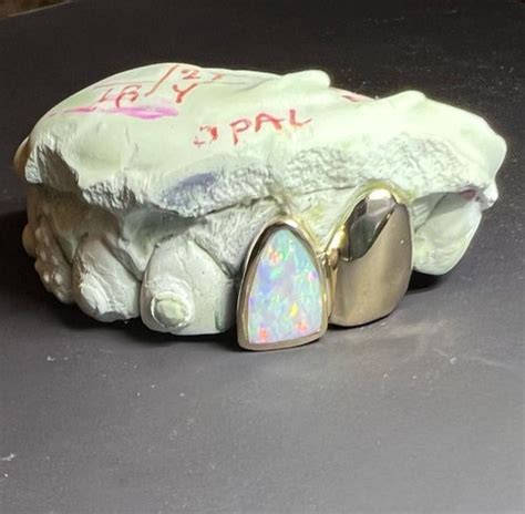 Custom Grillz — Illuminate Smile Specialists