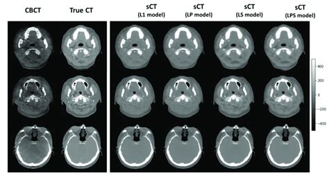 Examples Of Dl Output Images True Ct Cbct Synthetic Ct L Loss