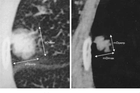 Mesothelioma Pleura Lung