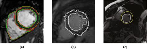 Traditional Segmentation Methods A Thresholding Automated Contours