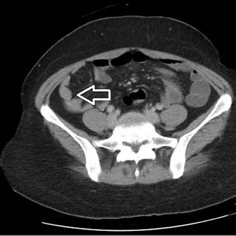 Ct Abdomen And Pelvis Showing Right Colonic Wall Patchy Thickening