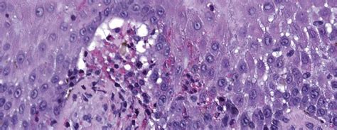 Virtual Grand Rounds In Dermatology 20 Dpp4 Inhibitor Drug Induced