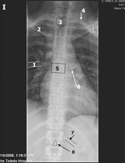 Ap Thoracic Spine Diagram Quizlet