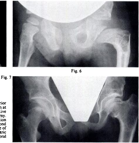 Figure 7 From Anterior And Posterior Displacement Of The Hip After Innominate Osteotomy