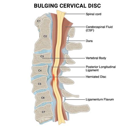 What Is The Difference Between Bulging And Herniated Disc All Difference