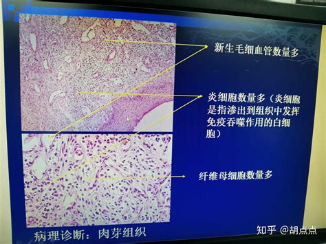 肾近曲小管上皮细脑水肿，肝脂肪变性，肉芽组织病理诊断及切片。 知乎