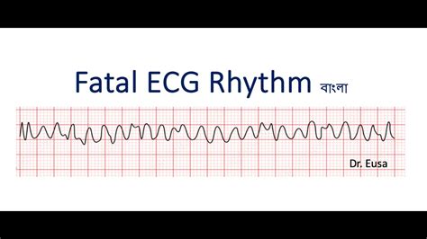 Fatal Ecg Rhythm Youtube