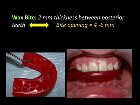 Tmds And Occlusal Splint Therapy
