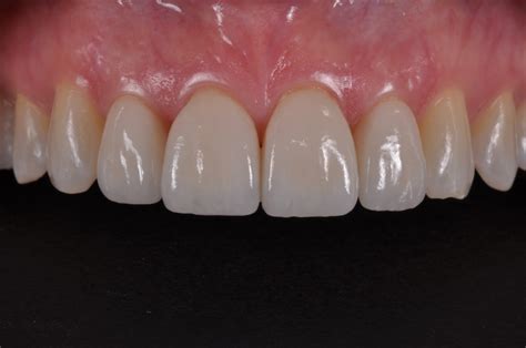 [request] teeth textures recommendation request and find skyrim non