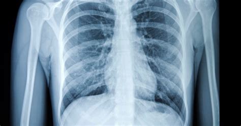 The First Ai Based Autonomous X Ray Cleared For Use In The Eu