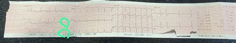 Afib Or Not Rekgs