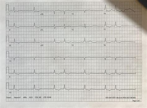 70yr Old Male With 1 Episode Of Syncope K C O Afib On Metoprolol And