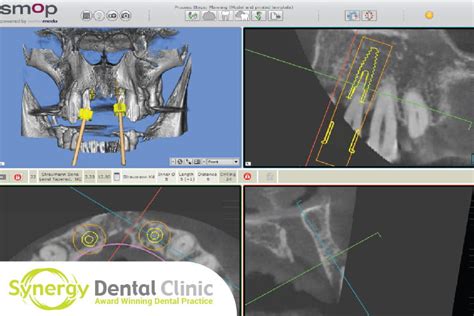 Case Study Will I Have An X Ray Or CT Scan Synergy Dental Clinic