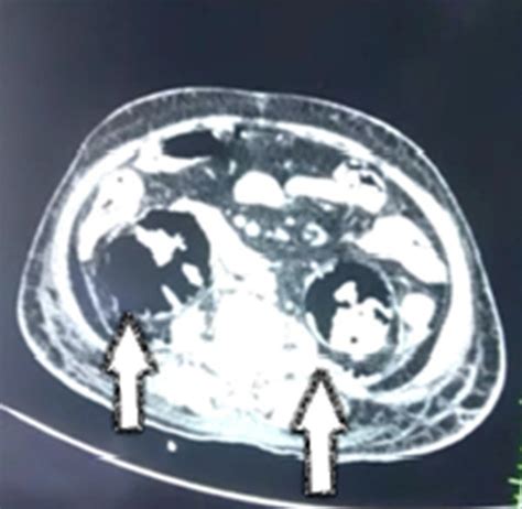 Bilateral Emphysematous Pyelonephritis Gas Replacing The Renal
