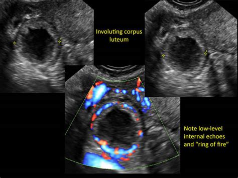 Corpus Luteum Ultrasound 1378x1563