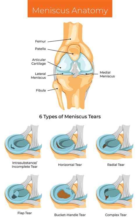 Meniscus Tear Surgery Explained