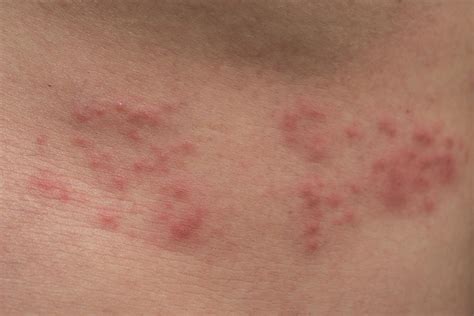 Eruption cutanée au visage comment reconnaître un zona
