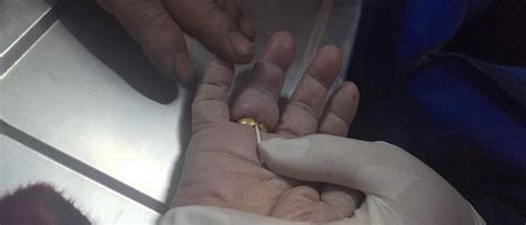 老人戒指“卡手”肿胀求助 消防紧急“破戒”腾讯新闻