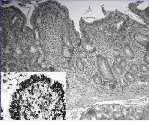 Duodenal Biopsy Showing Villous Atrophy And Severe Inflammation In The