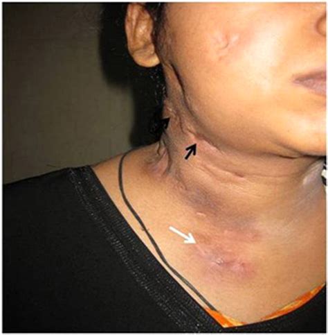Hiv And Lymphadenopathy Swollen Lymph Nodes