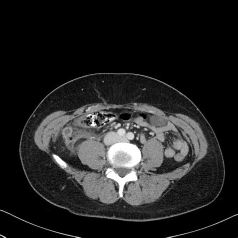 Radiopaedia Case Perforated Appendicitis Retrocecal Appendix Id