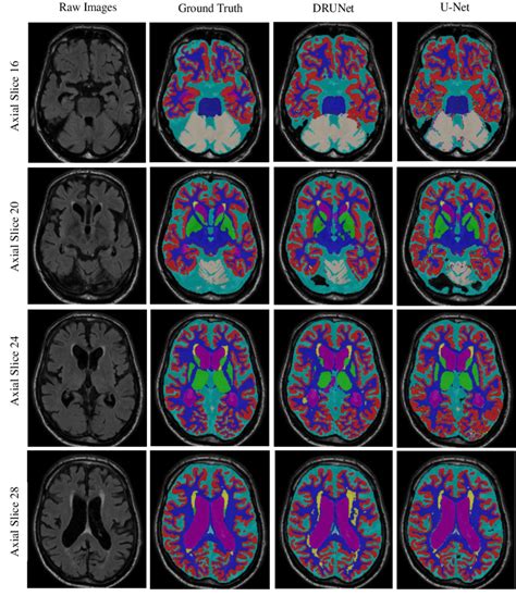 Sample Segmentation Result On Case 70 From Top To Bottom Four Axial