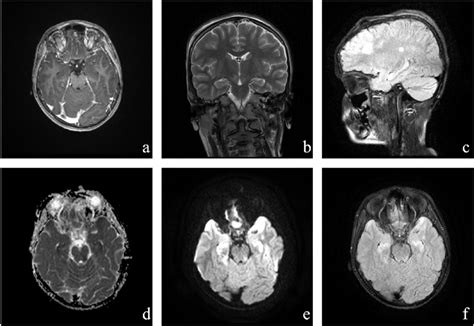 Axial T1 Weighted With Intravenous Contrast A Coronal T2 Weighted