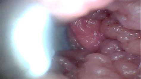 Endoscope Videos XVIDEOS COM Endoscope Videos XVIDEOS COM