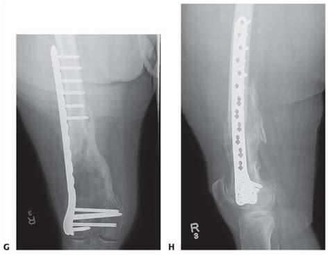 Open Reduction And Internal Fixation Of The Distal Femur