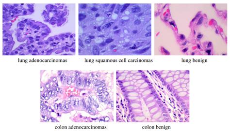 Github Mohamedbashirdiagnosis Lung And Colon Cancer Using Histopathological Images 🔬this