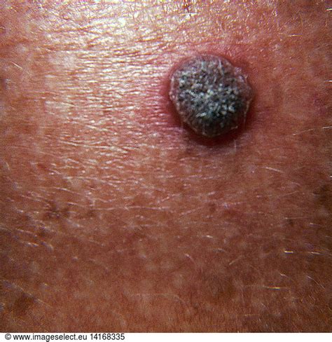 Seborrheic Keratosis Seborrheic Keratosis Dermatological Keratosis Neck