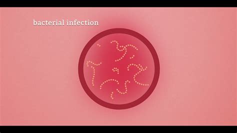 Cellulitis Youtube