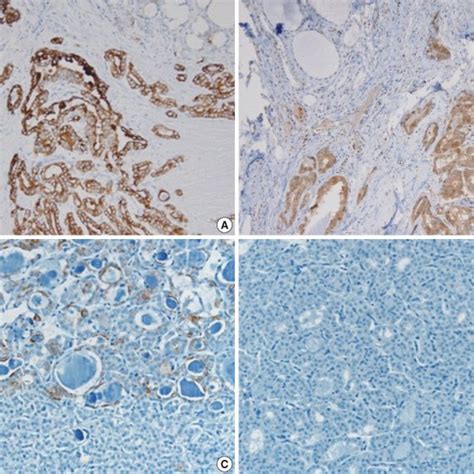 A B The Conventional Types In Multifocal Papillary Thyroid Carcinoma