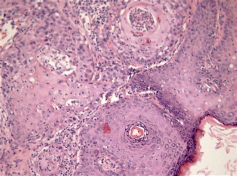 Tumor De Warthin Diagnóstico En Patología Bucal