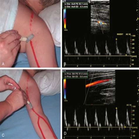 Usg Doppler Arterial And Venous Upper Limb Biilateral In Gurgaon Usg