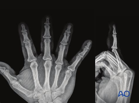 Highlights Of Hand Middle Phalanges