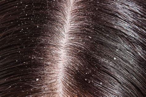 The Difference Between Dandruff And Product Build Up New York Barbers