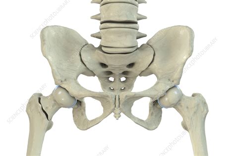 Basicervical Femur Fracture Illustration Stock Image F043 9243