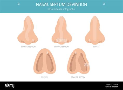 Nose Deviated Septum Nasal Diseases Medical Infographic Design Vector Illustration Stock