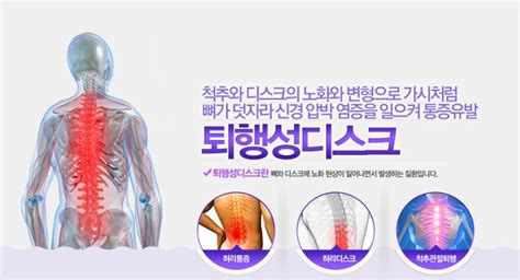 건강정보 퇴행성 디스크란 강서구 양천구 화곡동 우장산동 등촌동 가양동 발산동 마곡동 주간보호센터 봄 연세데이케어센터