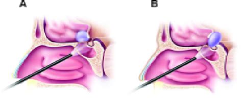Structure Of Suprasellar Region Semantic Scholar
