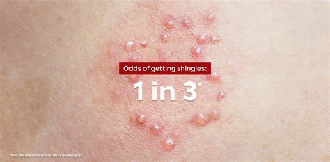 Shingrix Shingles Vaccine