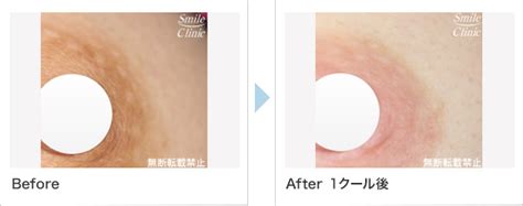 参考写真 黒ずみ スマイルクリニック｜新宿・銀座